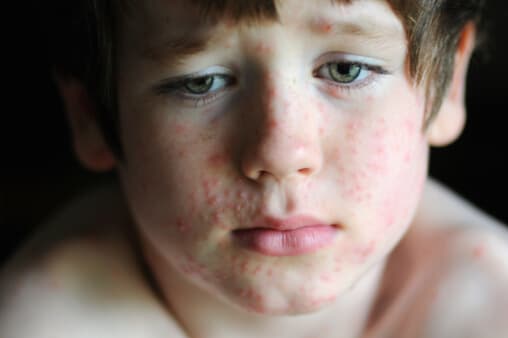 Exanthems: A-to-Z Guide from Diagnosis to Treatment to Prevention ...