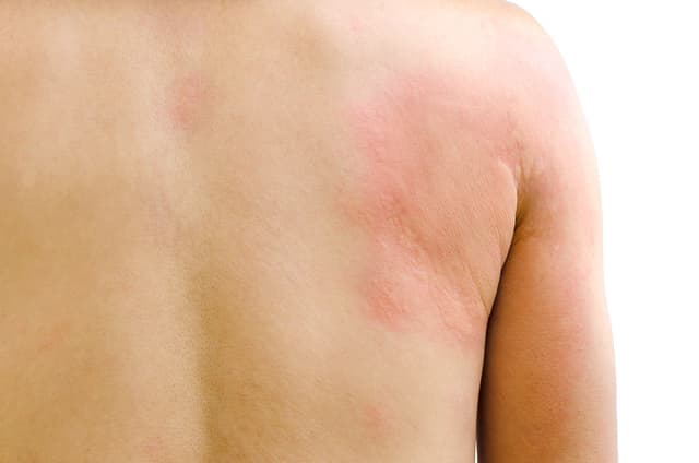 Hives: A-to-Z Guide from Diagnosis to Treatment to Prevention | DrGreene